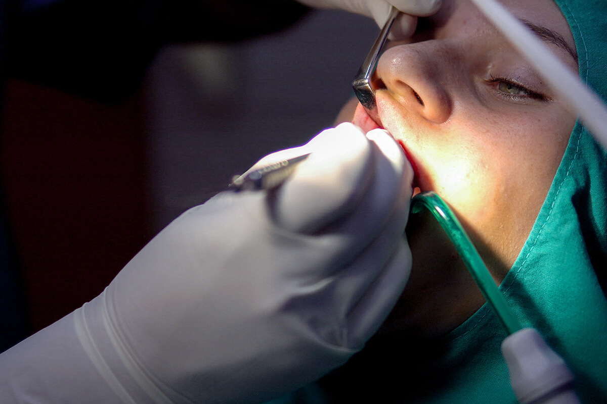 Apicoectomy Explained and How This Endodontic Surgery Works ...