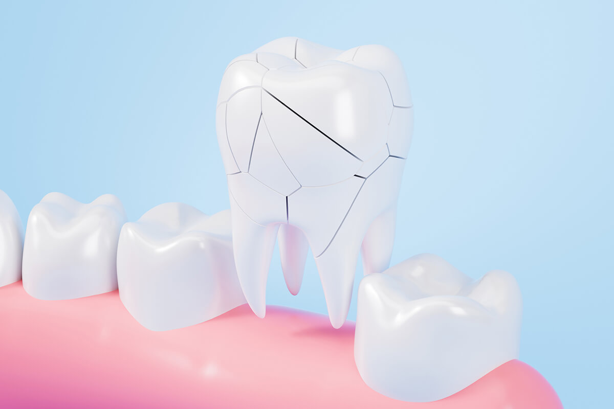 Can A Cracked Tooth Heal On Its Own? - Contemporary Endodontics of Oklahoma